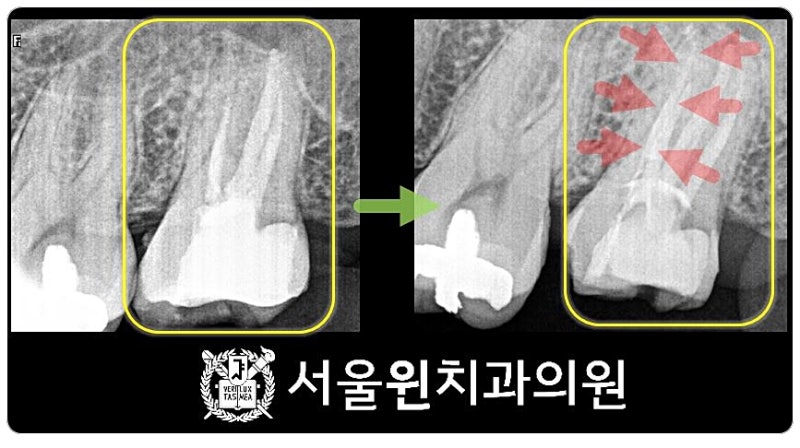 안내 서울윈치과 재신경치료 치료 사례 신경관 석회화 치수재감염 치아 끝 고름주머니 네이버 블로그