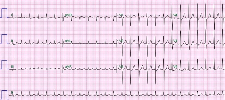 발작성 심실상성 빈맥(PSVT) 증례 : 네이버 블로그