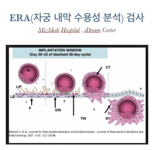 자궁 내막 수용성 분석 검사 Era 검사의 의미 중요성시행 방법국내 최초 도입 강서 미즈메디 병원 산부인과 아이드림