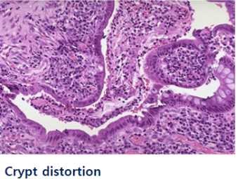 궤양성대장염(Ulcerative colitis) : 진단 및 검사 : 네이버 블로그