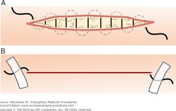 신장이식수술 시 피부 봉합의 방법(Subcuticular suture) "저는 실밥이 없어요!" : 네이버 블로그