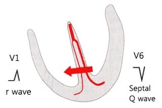 오래된 심근경색증에서 심전도 변화 : 네이버 블로그