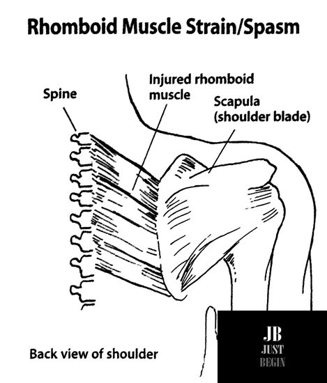 Rhomboid Muscle Strain or Spasm(능형근염좌/경련)의 증상,진단,치료 : 네이버 블로그