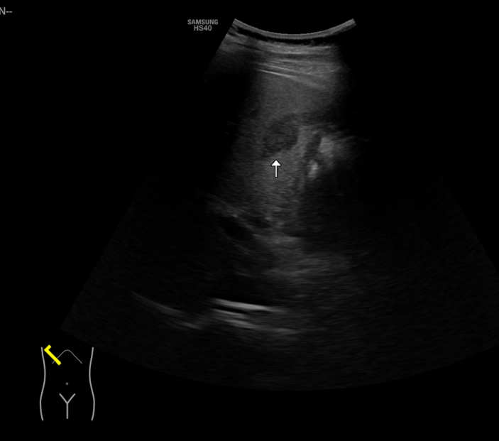 비만 환아에서의 초음파상 간의 국소성 지방결여, focal fat sparing of the liver : 네이버 블로그