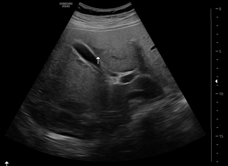 비만 환아에서의 초음파상 간의 국소성 지방결여, focal fat sparing of the liver : 네이버 블로그
