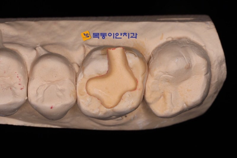 목동전문의임플란트오목교구강외과서울대치아교정원장연세대통합진료원장협진으로 완벽하게 네이버 블로그