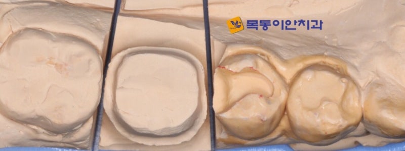 목동전문의임플란트오목교구강외과서울대치아교정원장연세대통합진료원장협진으로 완벽하게 네이버 블로그