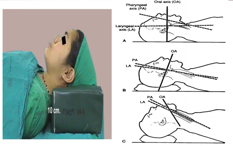Intubation(기관내삽관), Endotracheal tube(E-tube 간호, 고정, 적응증, 물품, 절차) : 네이버 블로그