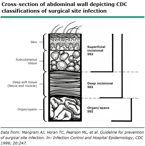 Wound Complication #3. SSI(Surgical Site Infection) 수술 부위 감염 : 네이버 블로그