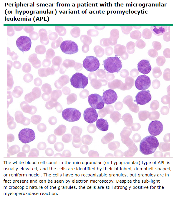 급성 전골수성 백혈병, 형태, Acute promyelocytic leukemia(APL), morphology : 네이버 블로그