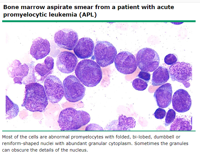 급성 전골수성 백혈병, 형태, Acute promyelocytic leukemia(APL), morphology : 네이버 블로그