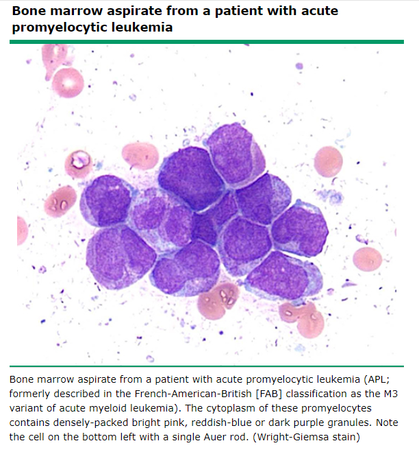 급성 전골수성 백혈병, 형태, Acute promyelocytic leukemia(APL), morphology : 네이버 블로그