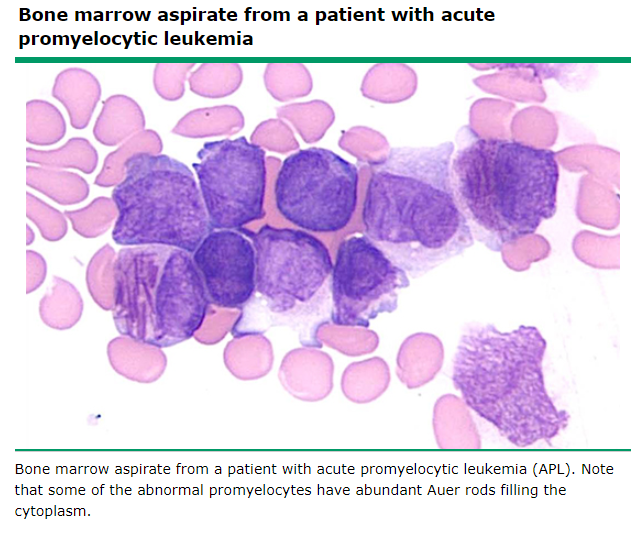 급성 전골수성 백혈병, 형태, Acute promyelocytic leukemia(APL), morphology : 네이버 블로그