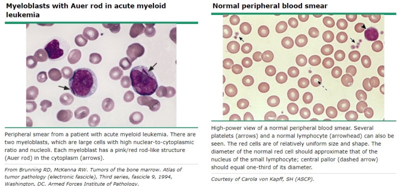 Auer rods, Auer bodies : 네이버 블로그