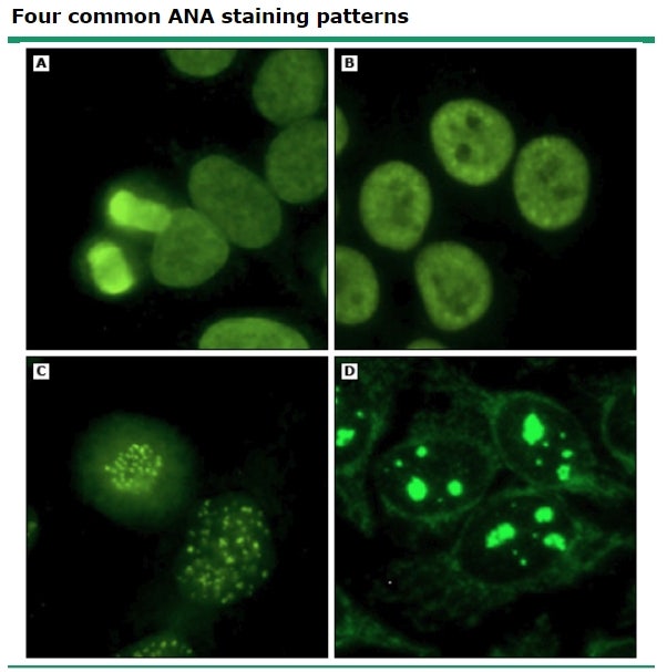 항핵항체 염색 양상의 의미, Significance of ANA staining patterns : 네이버 블로그
