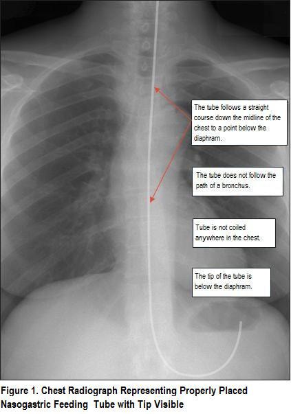 L-tube Feeding(levin tube) 비위관 삽입(경관영양, 경장영양) : 네이버 블로그