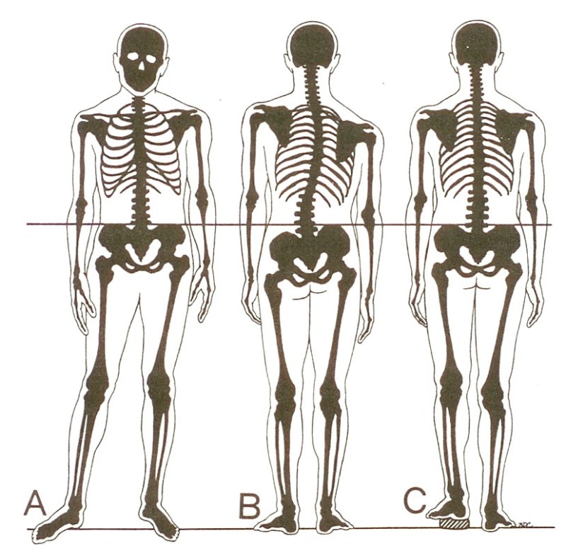 만성골반통증 환자와 골반뒤틀림(Pelvic distortion)과의 관계 : 네이버 블로그