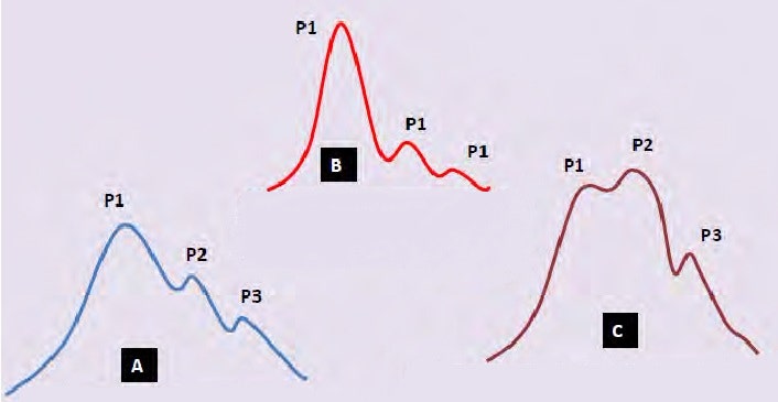 Intracranial Pressure(ICP) Monitoring, 두개내압 감시 및 측정 : 네이버 블로그