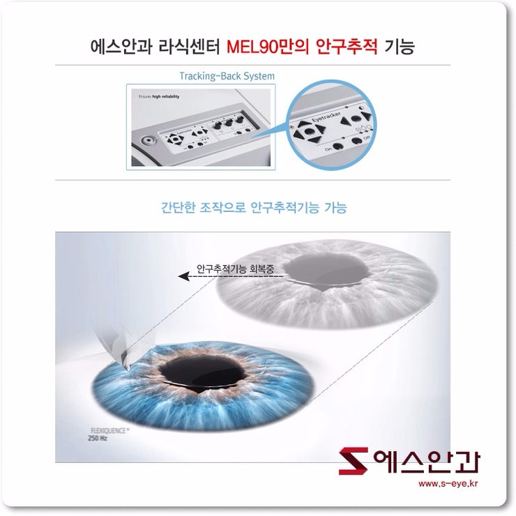 안산라식수술 기기들은 어떤것이 있나요? : 네이버 블로그