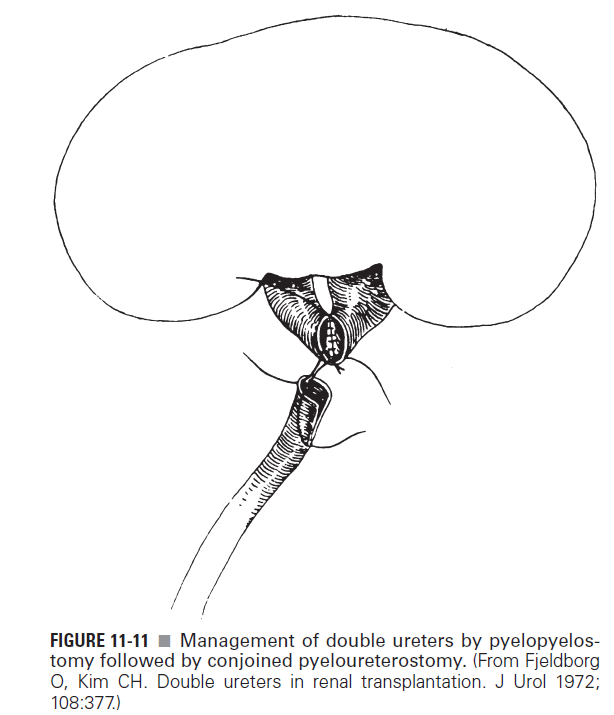 중복요관(duplicated ureter)을 가진 신장 기증자 : 네이버 블로그