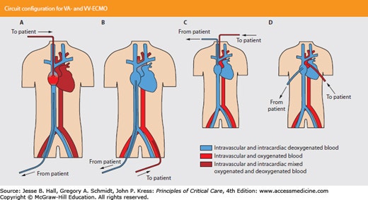 ECMO(에크모) 치료,간호 및 환자관리. Extracorporeal Membrane Oxygenation(VA,VV type ...