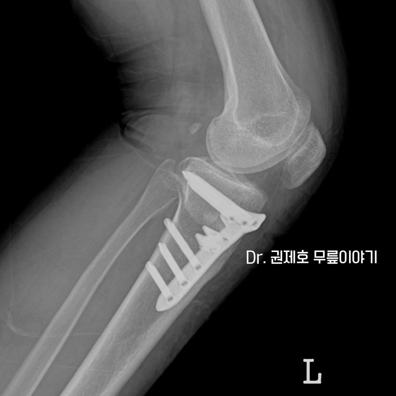 무릎절골술 연골판파열 중 뿌리파열의 증상이 호전 안된다면 네이버 블로그