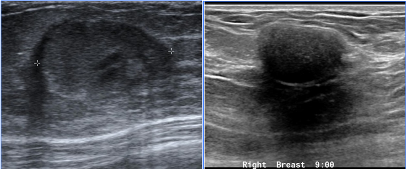 galactocele(milk retention cyst) : 네이버 블로그
