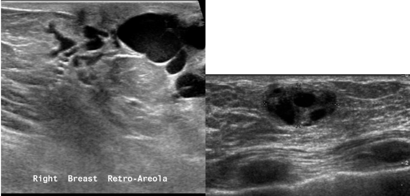 galactocele(milk retention cyst) : 네이버 블로그