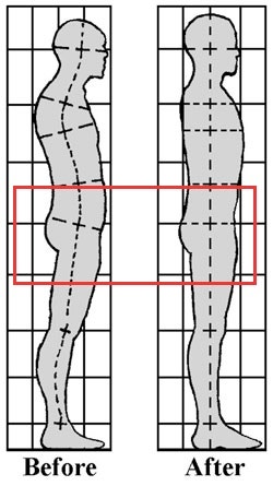 오랜기간 잘 낫지 않는 만성골반통증증후군(CPPS), 골반저기능장애(PFD)와 골반 및 자세와의 관련성 : 네이버 블로그