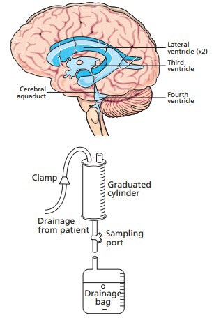 EVD[External Ventricular Drainage] : 뇌실 외 배액. 간호. : 네이버 블로그
