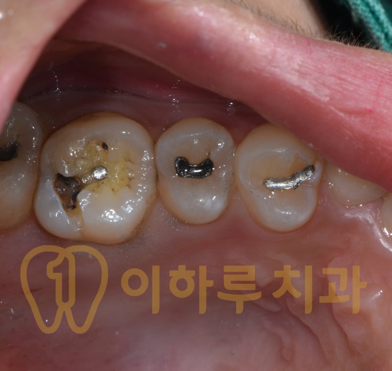 글래스아이노머 보험 재료로 2차 충치 치료 신촌치과 네이버 블로그