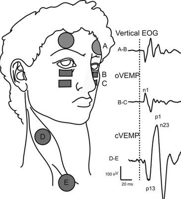 전정유발근전위(VEMP): 증거는 무엇인가? : 네이버 블로그