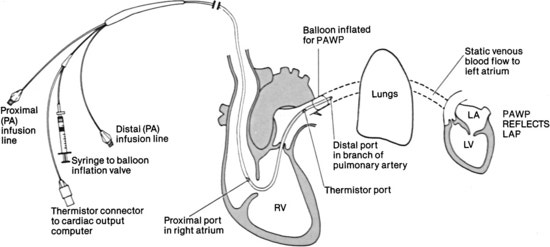 Swan-Ganz Catheter[폐동맥카테터] 목적, 구성, 적응증 : 네이버 블로그
