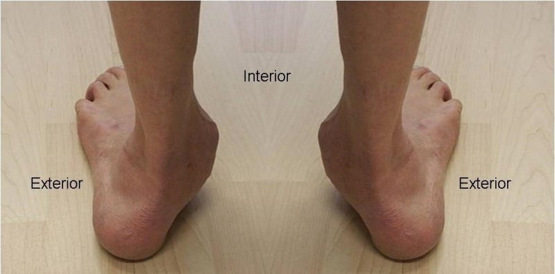 위례리본정형외과: 소아 평발 (上) : 네이버 블로그