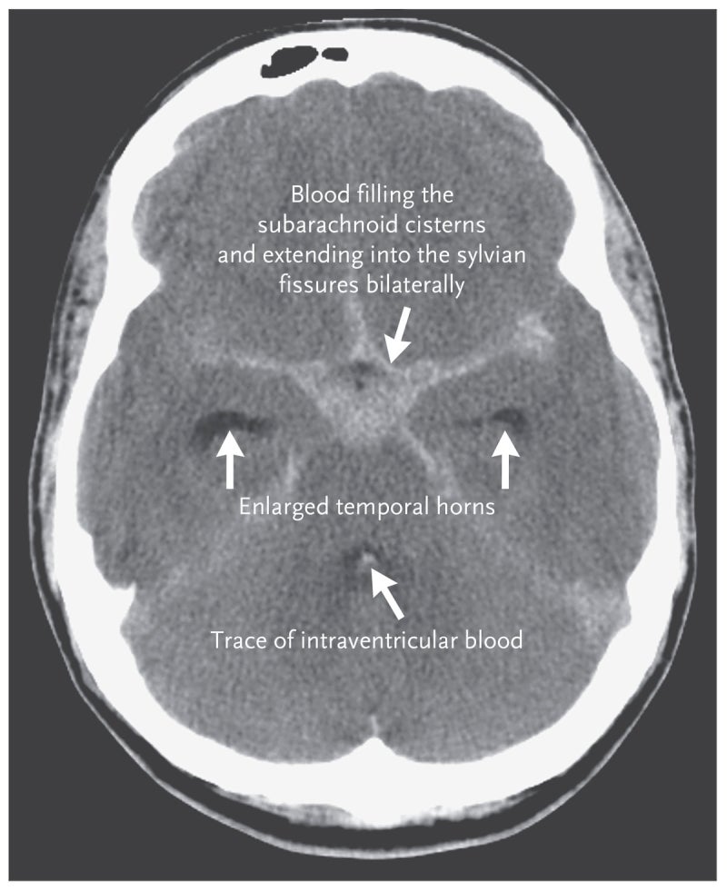 Cerebral hemorrhage의 종류 : 네이버 블로그