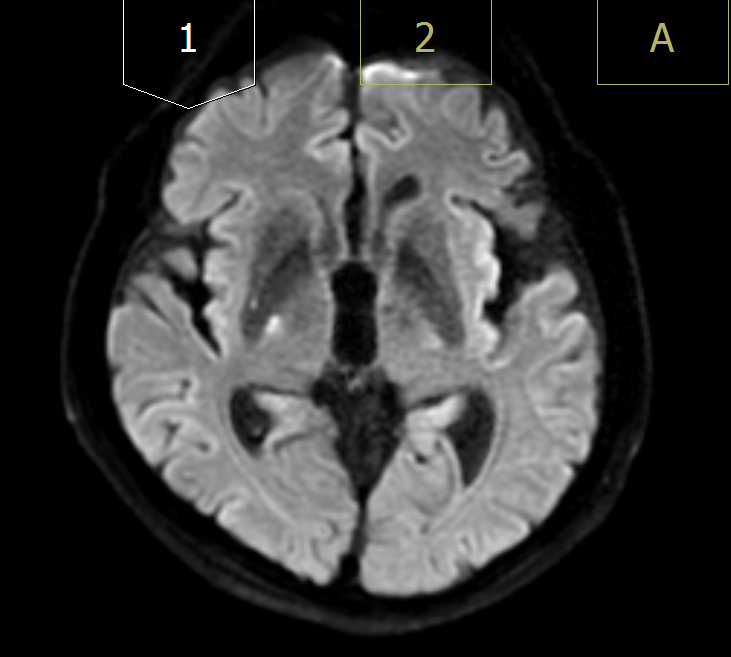 Corona radiata :corticopontine tract, the corticobulbar tract, and the ...