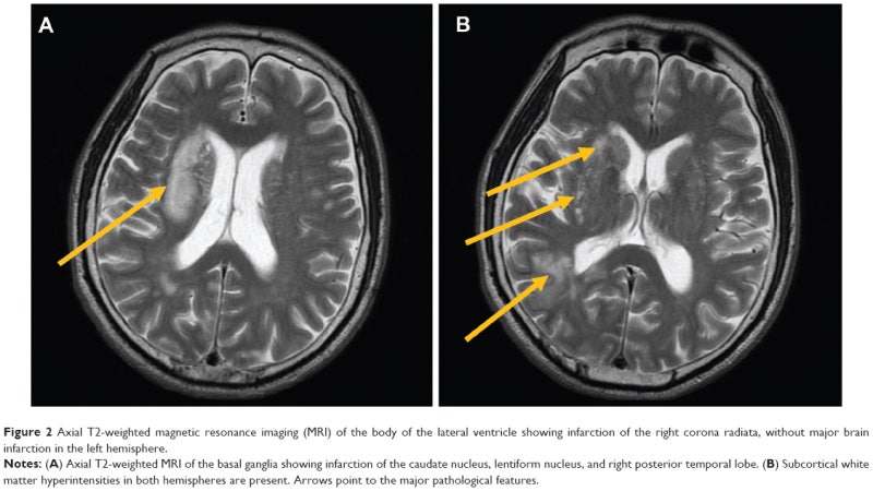 Corona radiata :corticopontine tract, the corticobulbar tract, and the ...