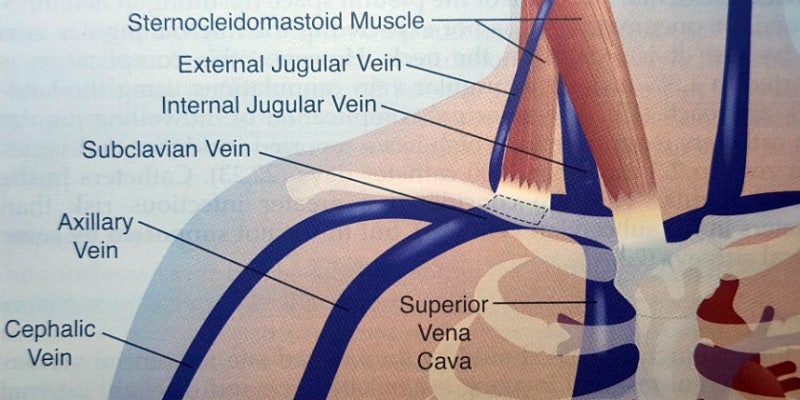 Central venous access - Subclavian vein : 네이버 블로그