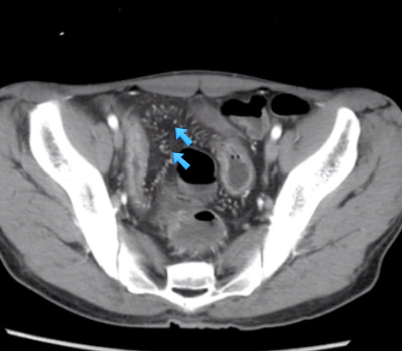 Comb sign, Crohn disease, CT : 네이버 블로그