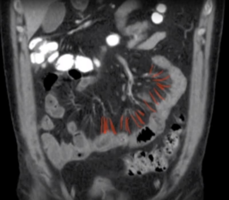 Comb sign, Crohn disease, CT : 네이버 블로그