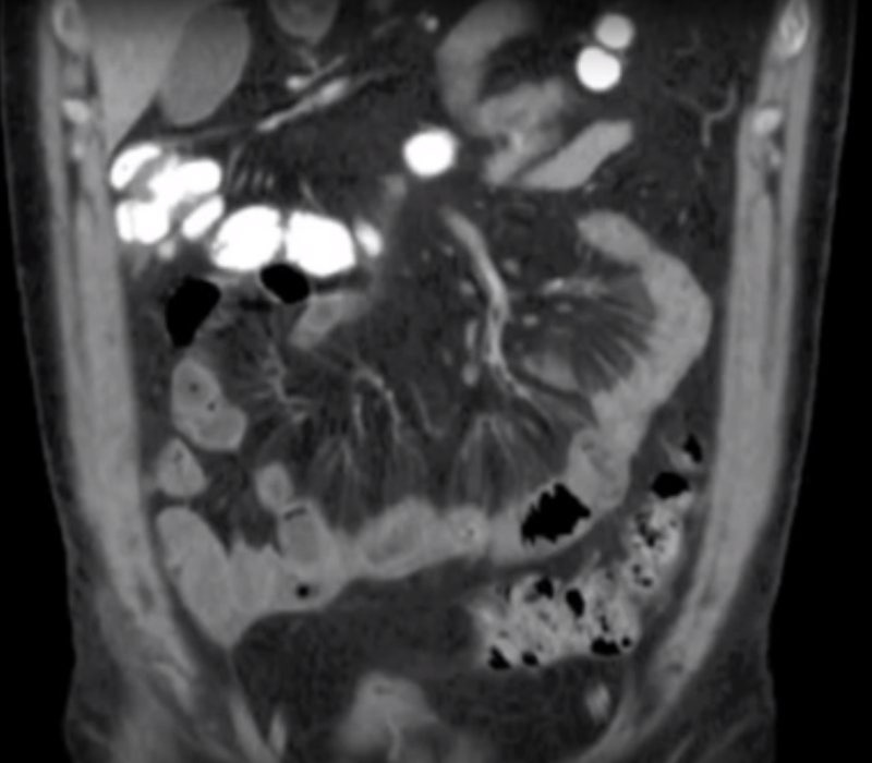 Comb sign, Crohn disease, CT : 네이버 블로그