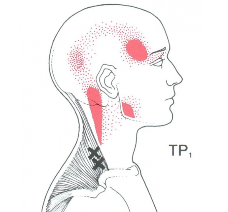 [수원 광교 필라테스] 유발점(trigger point), 압통점(tender points)의 의미와 다른 점은 무엇일까 ...
