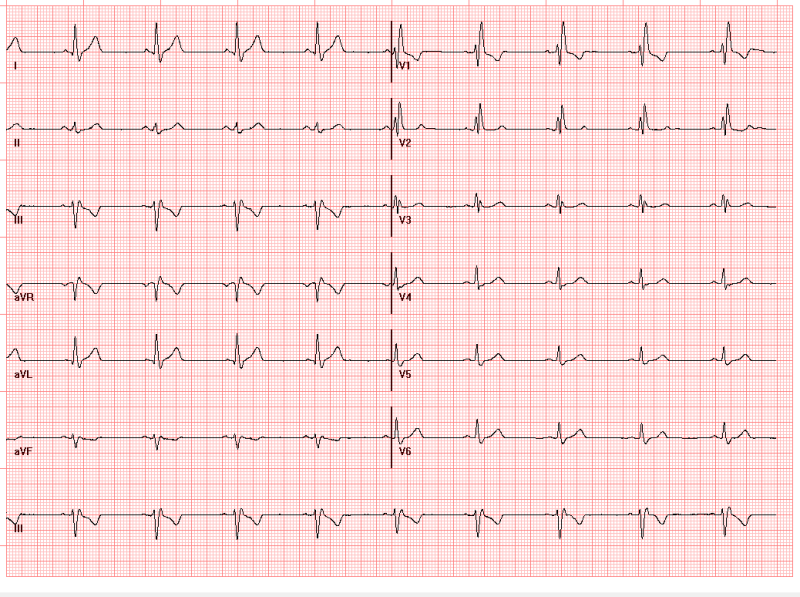 완전 우각차단, 치료, Complete RBBB, treatment : 네이버 블로그