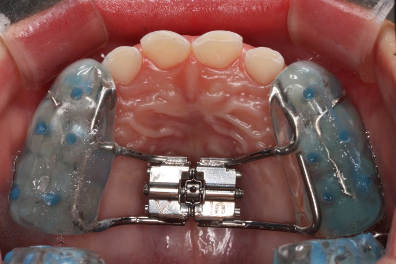 *전치부 반대교합의 bonded RPE + Facemask 치료* 제 19편 Dr.Jung의 치아교정 이야기 : 네이버 블로그