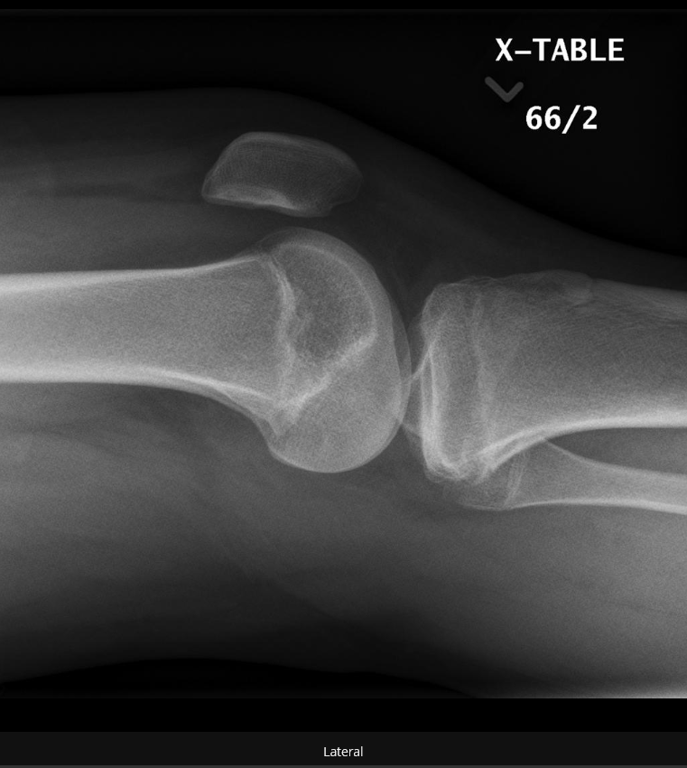 Arcuate sign : 네이버 블로그