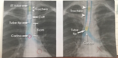 [ICU] 기관내삽관 Intubation / E-tube(Endotracheal tube) : 네이버 블로그