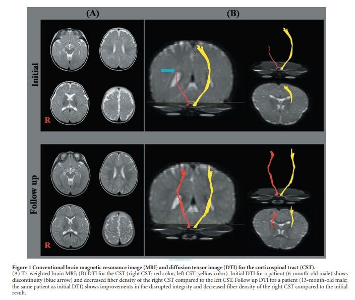 Diffusion Tensor Tractography DTT : 네이버 블로그
