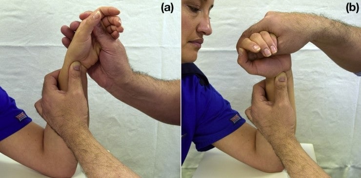 [손목] Scapholunate dysfunction & SLAC wrist : 네이버 블로그