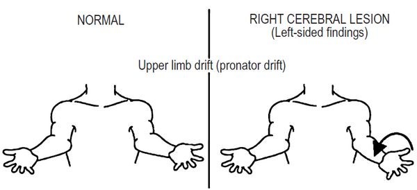 [신경학 63] 어깨 외전검사시 the Pronator test : 네이버 블로그
