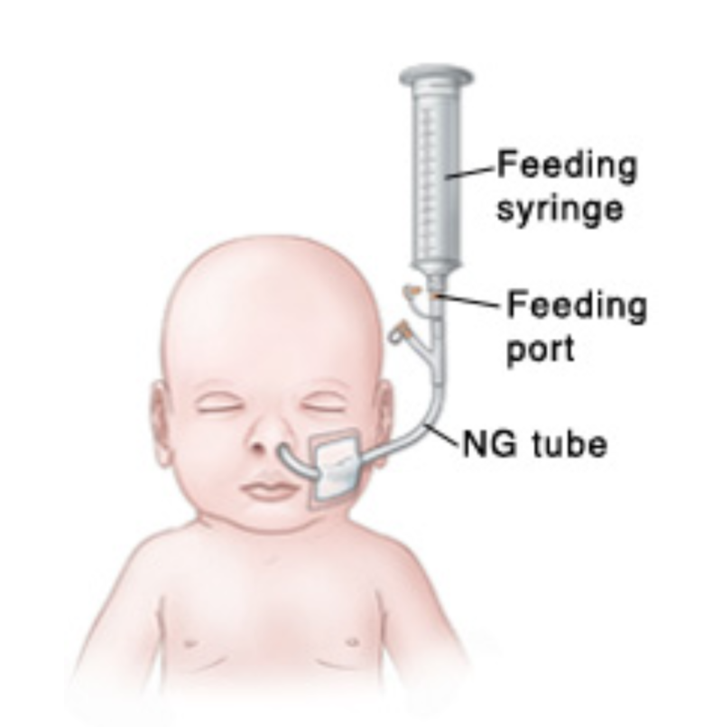 2018.11.20 NG tube vs G tube 외에 T tube : 네이버 블로그